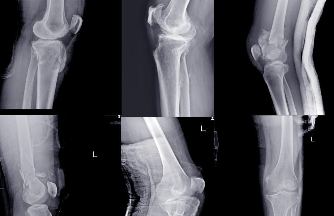 A Complete Guide on How Fractures Heal - Dr Ashish Suryawanshi, Best ...