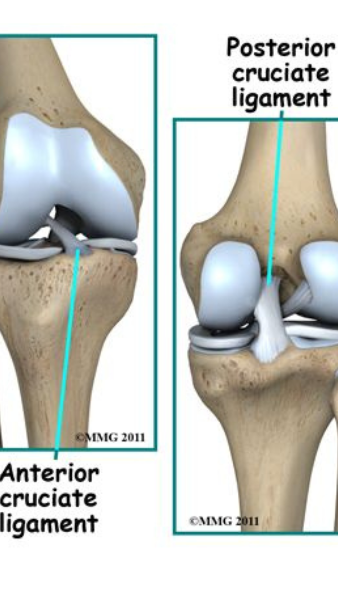 ACL, PCL & Ligament Reconstruction: What to Expect Before, During ...